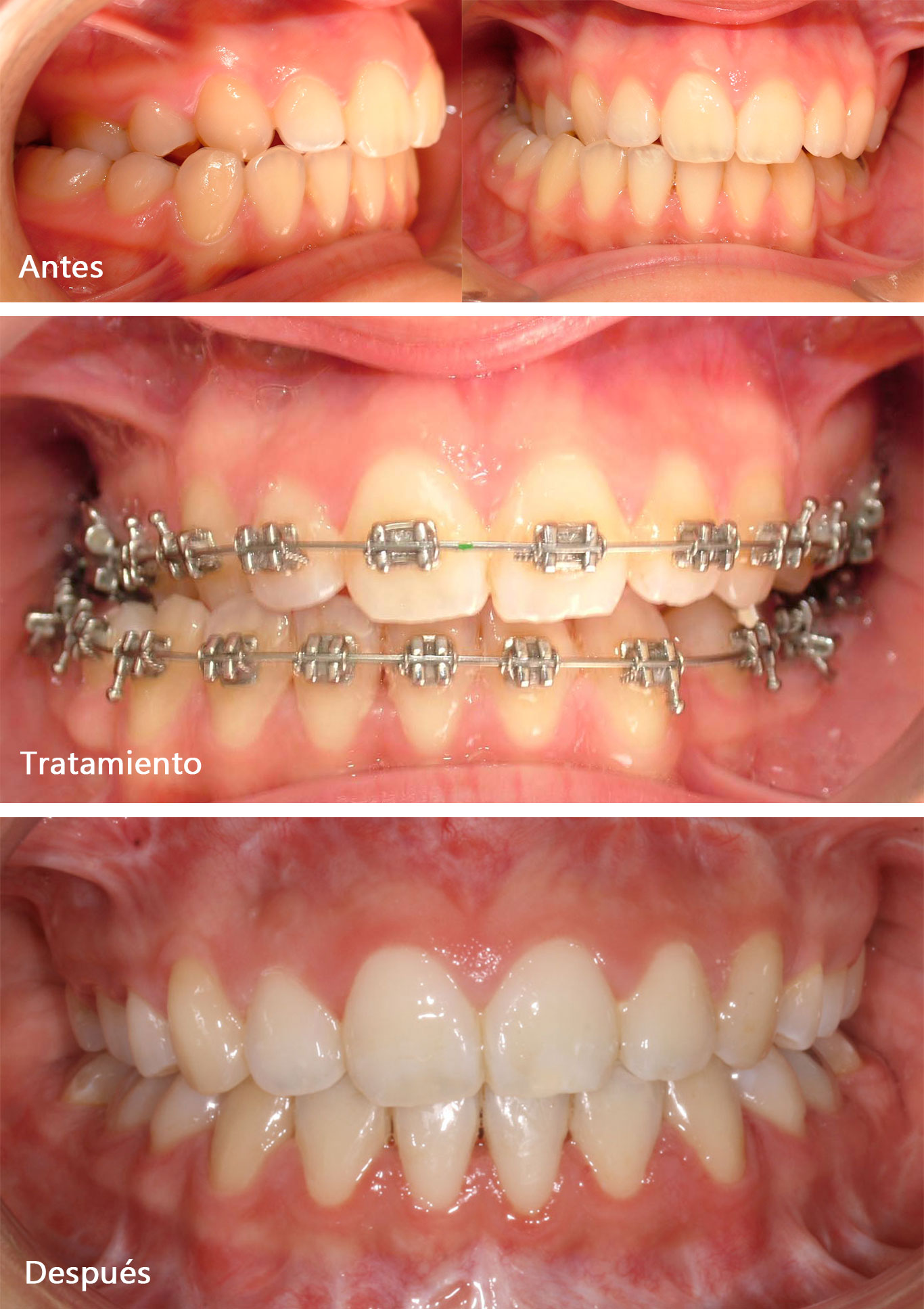 Paciente con hiperplasia condílea izquierda (Exceso de crecimiento ...